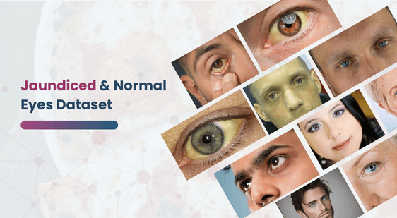 Jaundiced & Normal Eyes Dataset for AI: Classification & Detection