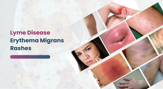 Lyme Disease Erythema Migrans Rashes Dataset for AI & Medical